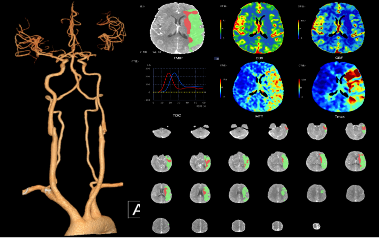 脑血管AI再添里程碑！数坤科技脑灌注智能评估系统获FDA认证-数坤科技官方网站